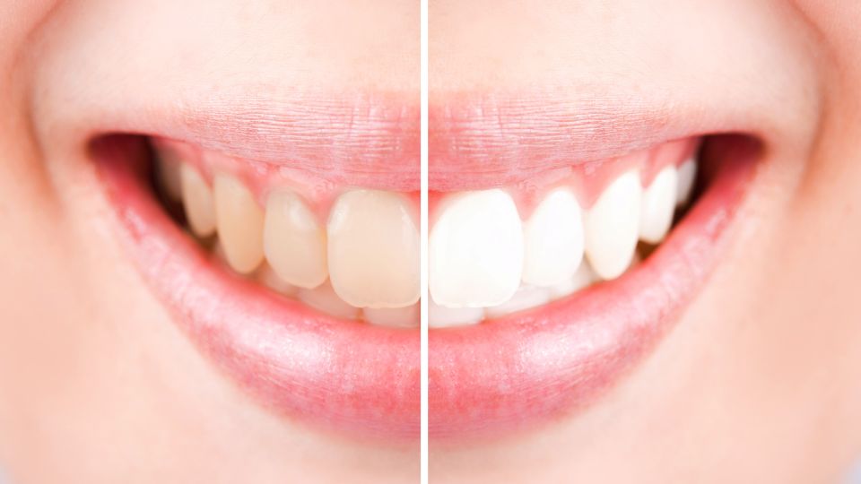 Denti gialli? Ecco le possibili cause e i rimedi - merident